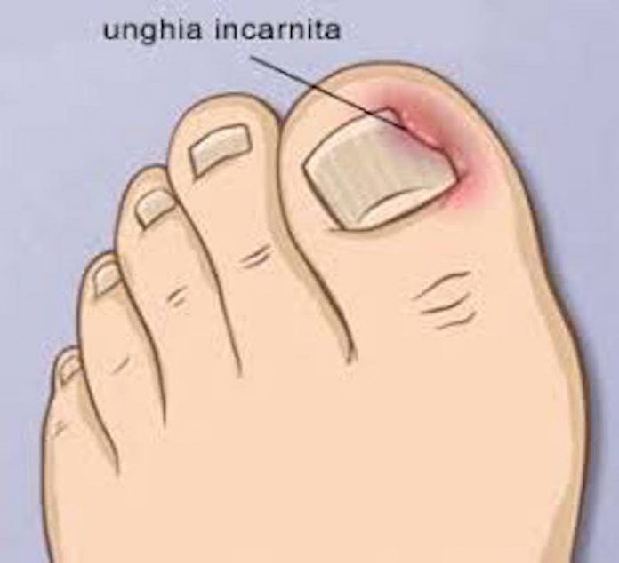 Unghia incarnita: il rimedio per curarla in soli 10 minuti Unghia incarnita: il rimedio per curarla in soli 10 minuti