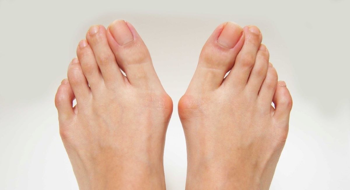 Alluce valgo, il potentissimo antinfiammatorio naturale per alleviare ...