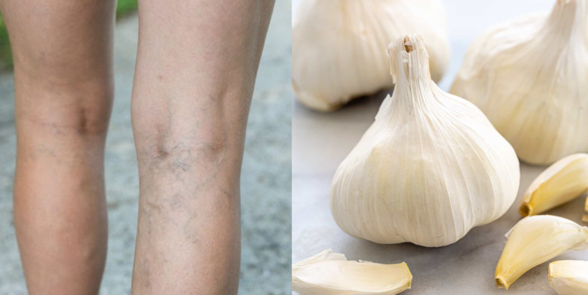 Vene varicose, hai mai provato a trattarle con l’aglio? Si fa così ...