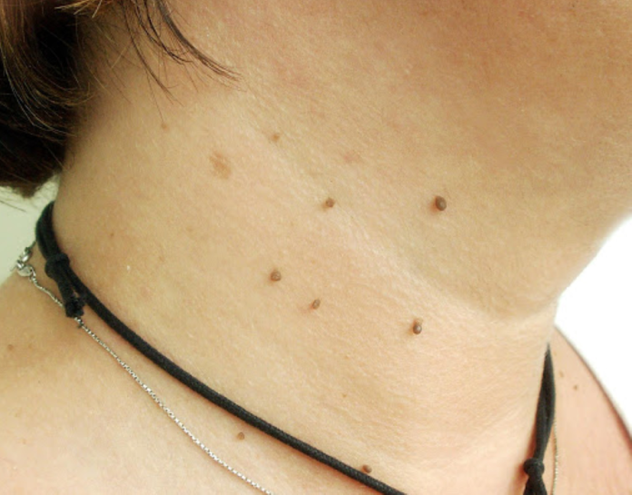 Fibromi penduli, come eliminare i "ciccetti" della pelle